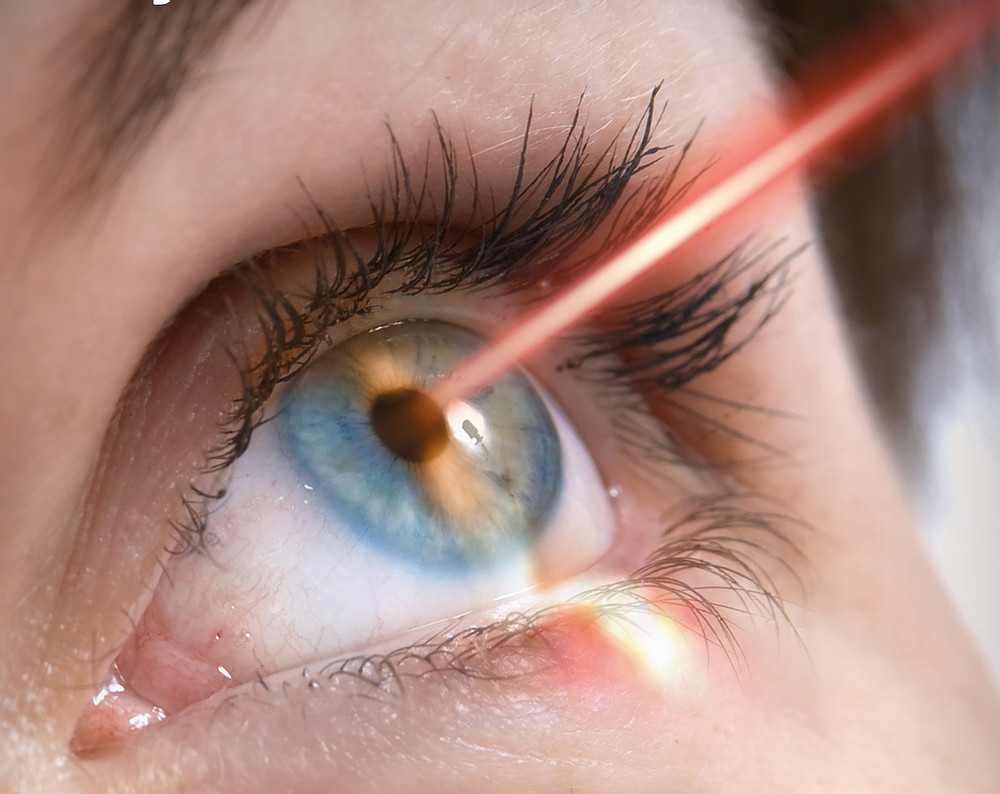 What Are The Advantages Of Smile Eye Surgery Fitness And Health Advisor What Are The Advantages Of Smile Eye Surgery Fitness And Health Advisor